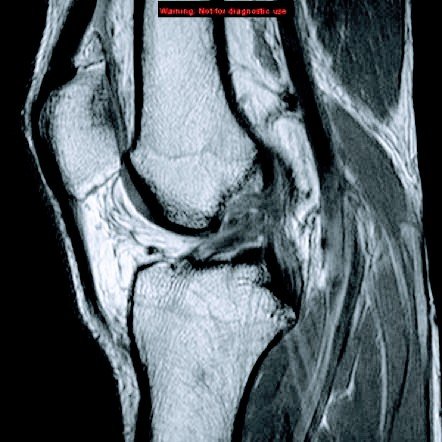 Diagnosis of ACL Tear or Injury - PT Master Guide