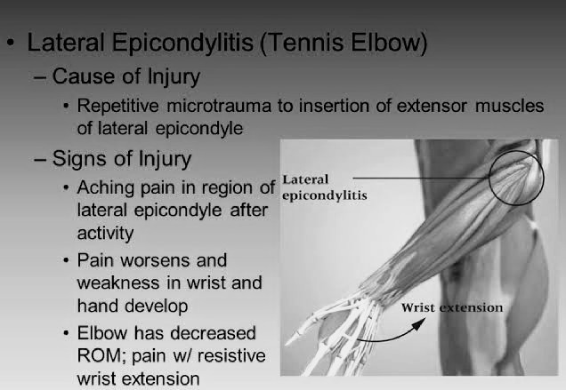 Symptoms of Tennis Elbow - PT Master Guide