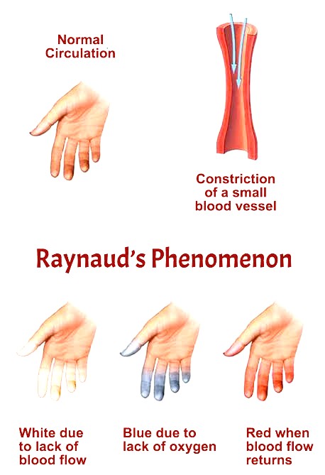 What is Raynaud's Phenomenon? - PT Master Guide