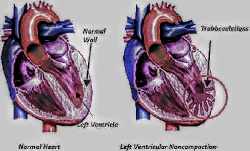 Left Ventricular Non-Compaction Cardiomyopathy - PT Master Guide