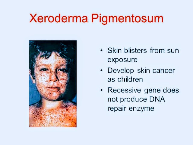 Xeroderma Pigmentosum Genes Cancer Genetics And Genomics – Part 1