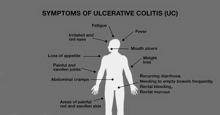 Symptoms of ulcerative colitis - PT Master Guide