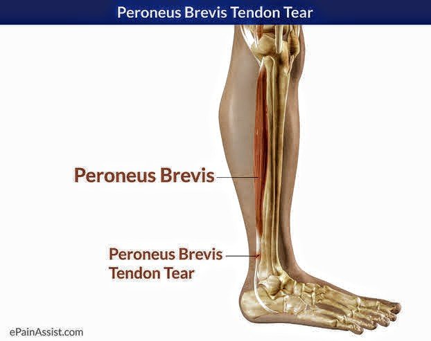 Peroneus brevis muscle - PT Master Guide