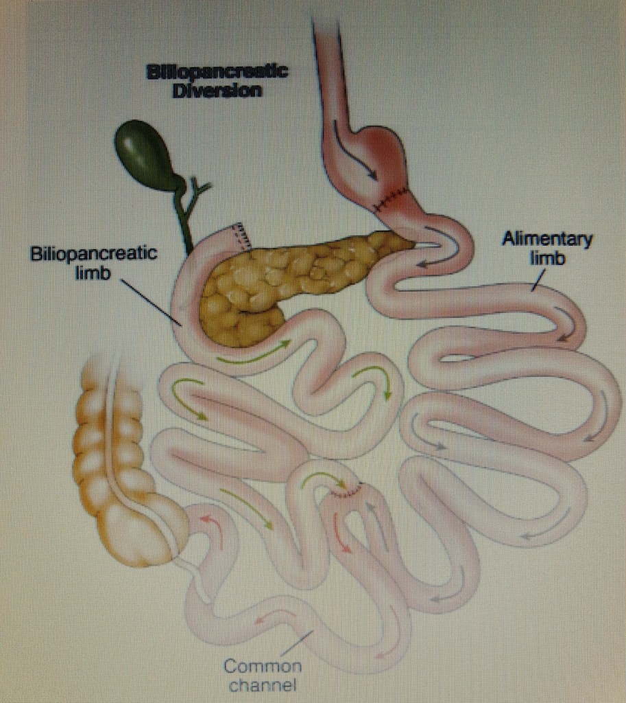 Biliopancreatic Diversion - PT Master Guide